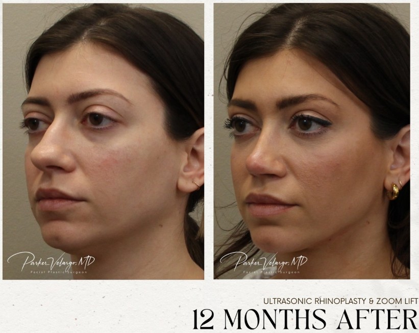 MyEllevate/Zoom Lift New Orleans | New Orleans Center for Aesthetics ...
