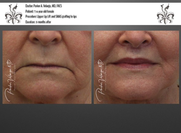 Lip Augmentation & Reduction | New Orleans Center for Aesthetics and ...