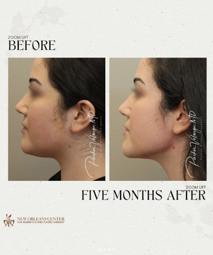 MyEllevate/Zoom Lift New Orleans | New Orleans Center for Aesthetics ...